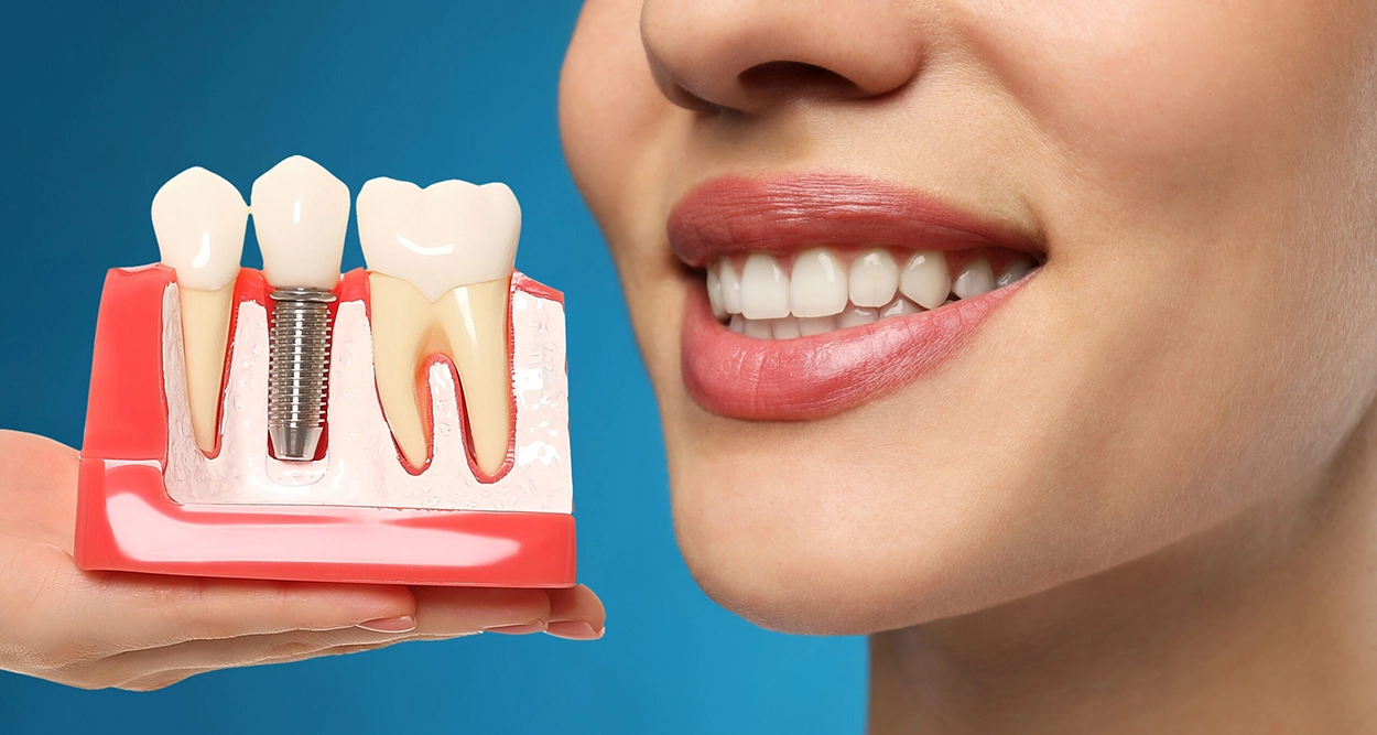 What is Dental Implants Restoration? | Dalton Dental